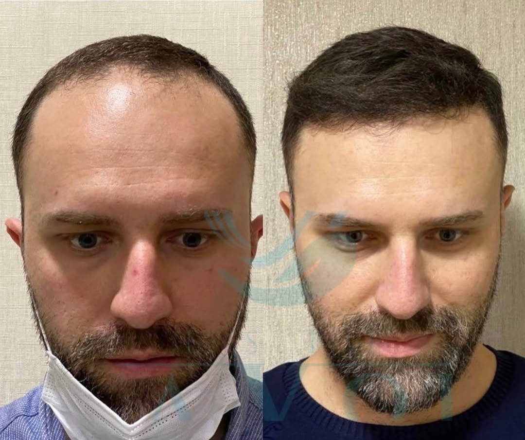 Turkey Hair Transplant Packages: What's Included in 2025? - Hair ...